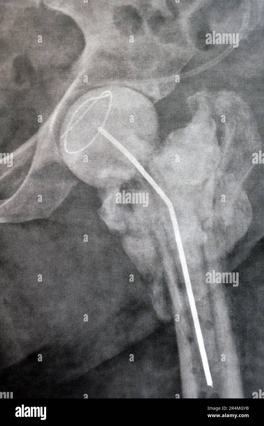 Plain X ray hip joint show left trans cervical fracture of the head of ...