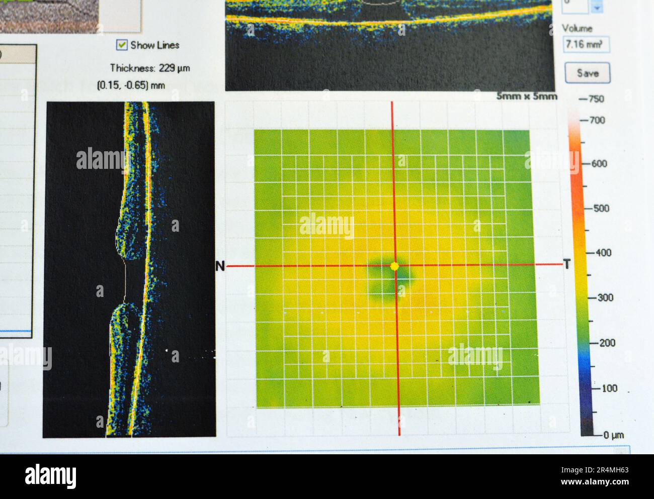 OCT of the eye reveals faint epimacular membrane and full thickness ...