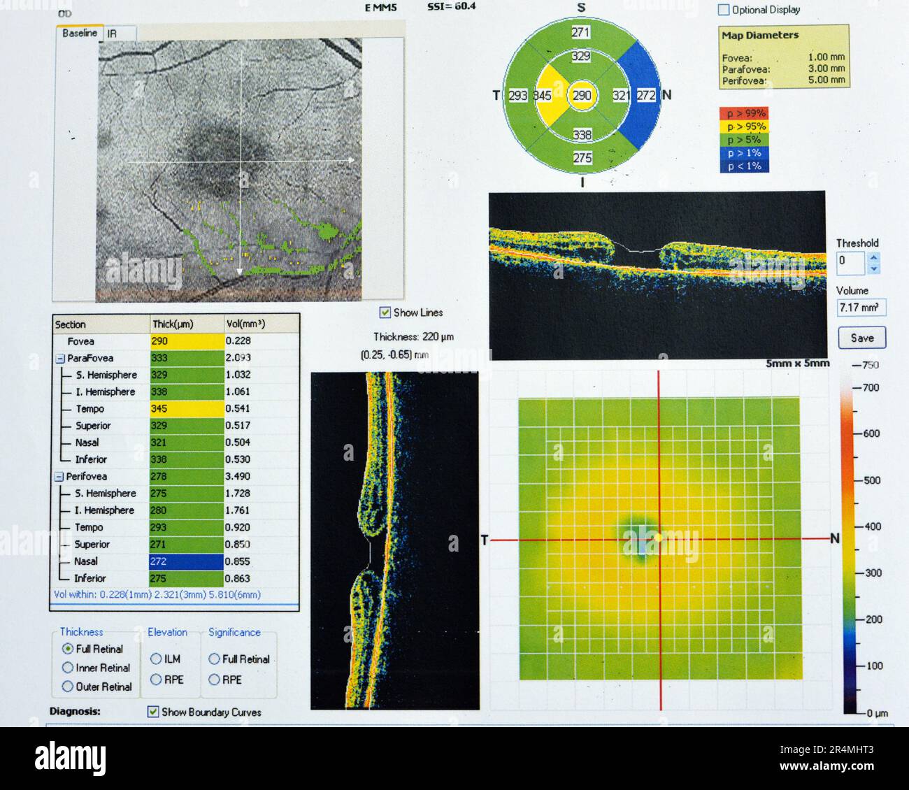 OCT of the eye reveals faint epimacular membrane and full thickness ...