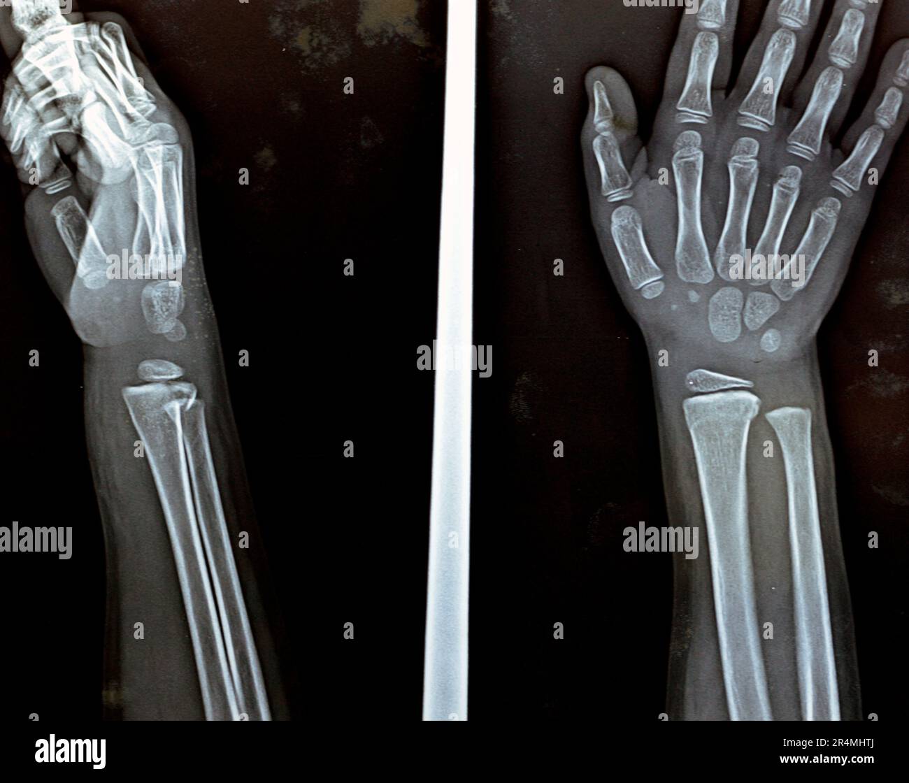A PXR plain x ray of right wrist joint of skeletally immature female ...