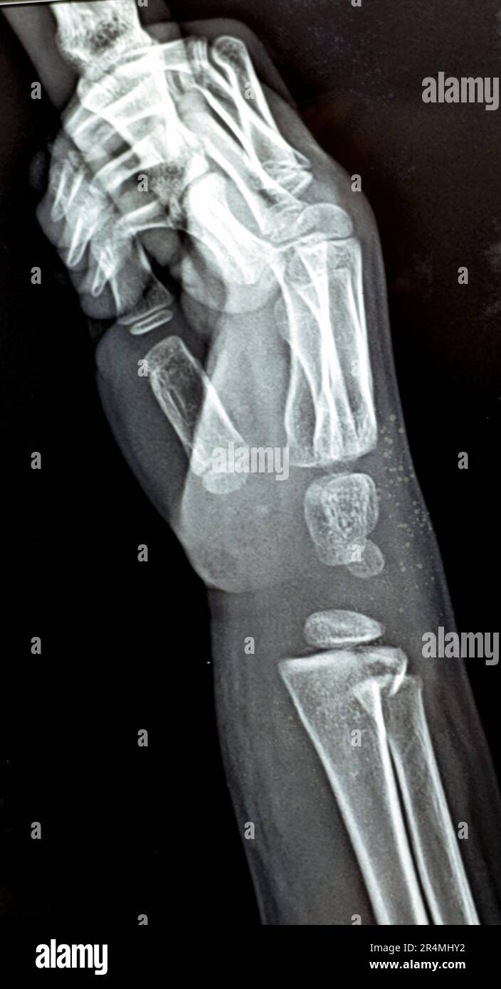 A PXR plain x ray of right wrist joint of skeletally immature female ...