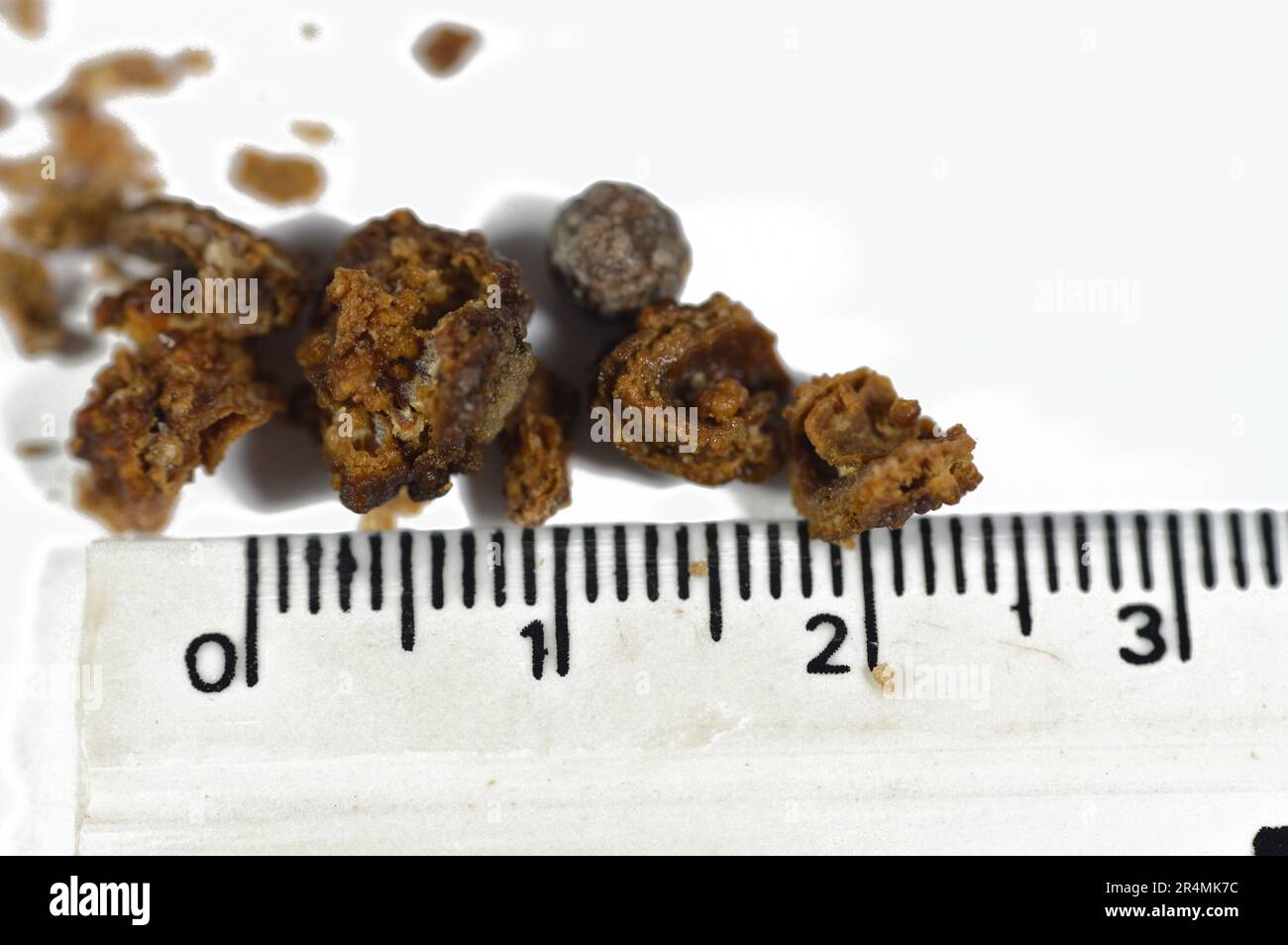 Nephrolithiasis, irregular brown kidney stones (renal calculus or ...