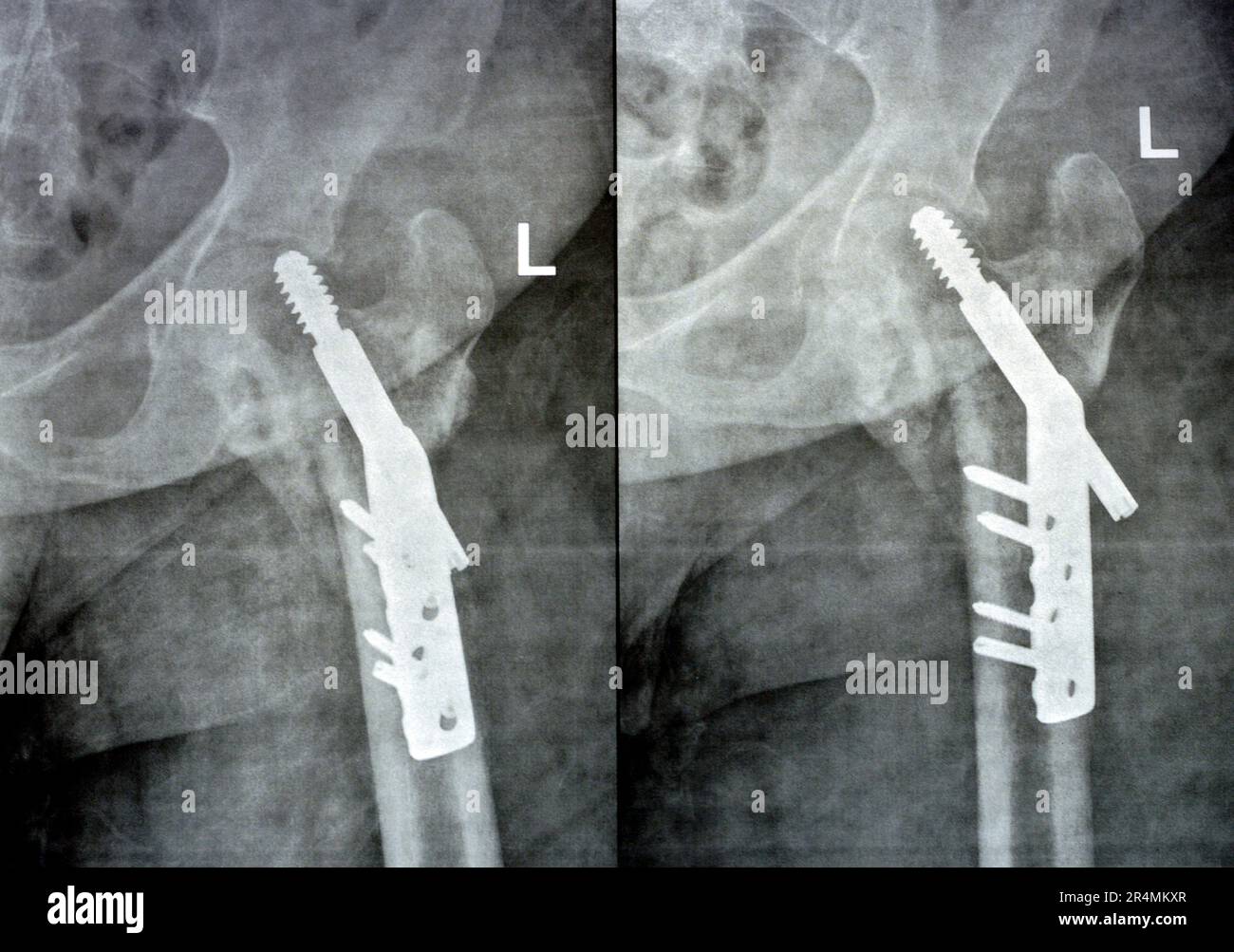 Left Hip Trans Cervical Neck Of Femur Fracture Fixated By Dhs Dynamic