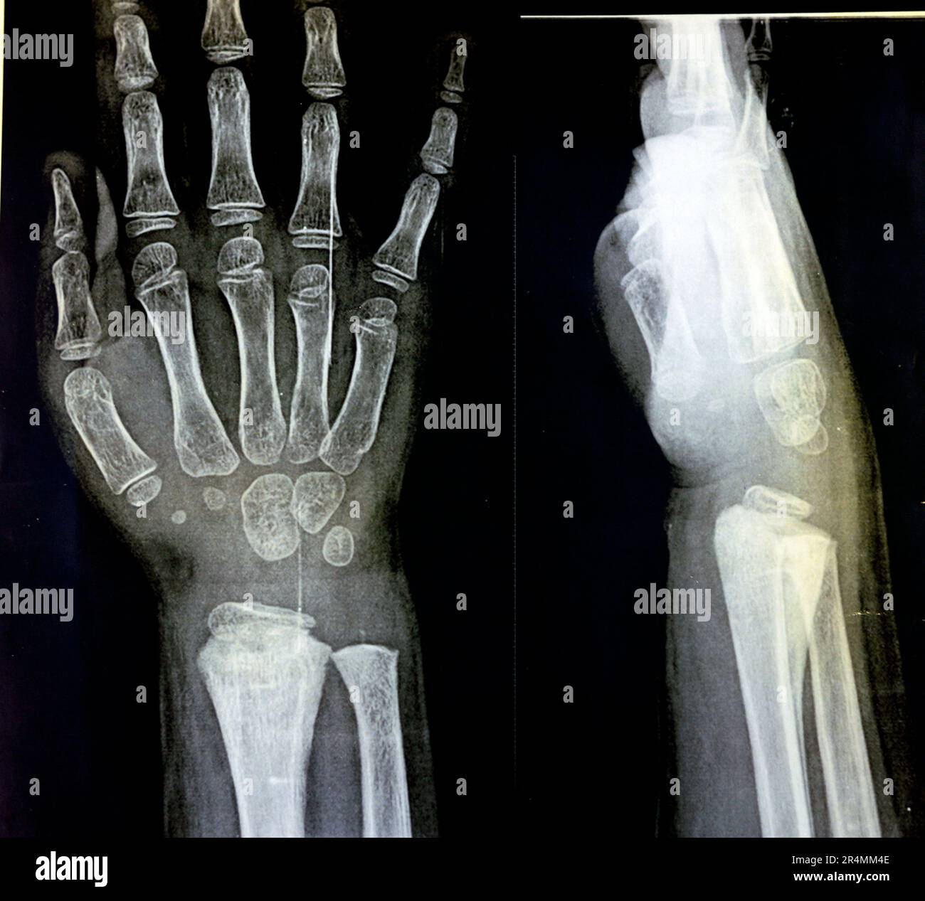 A PXR plain x ray of right wrist joint of skeletally immature female ...