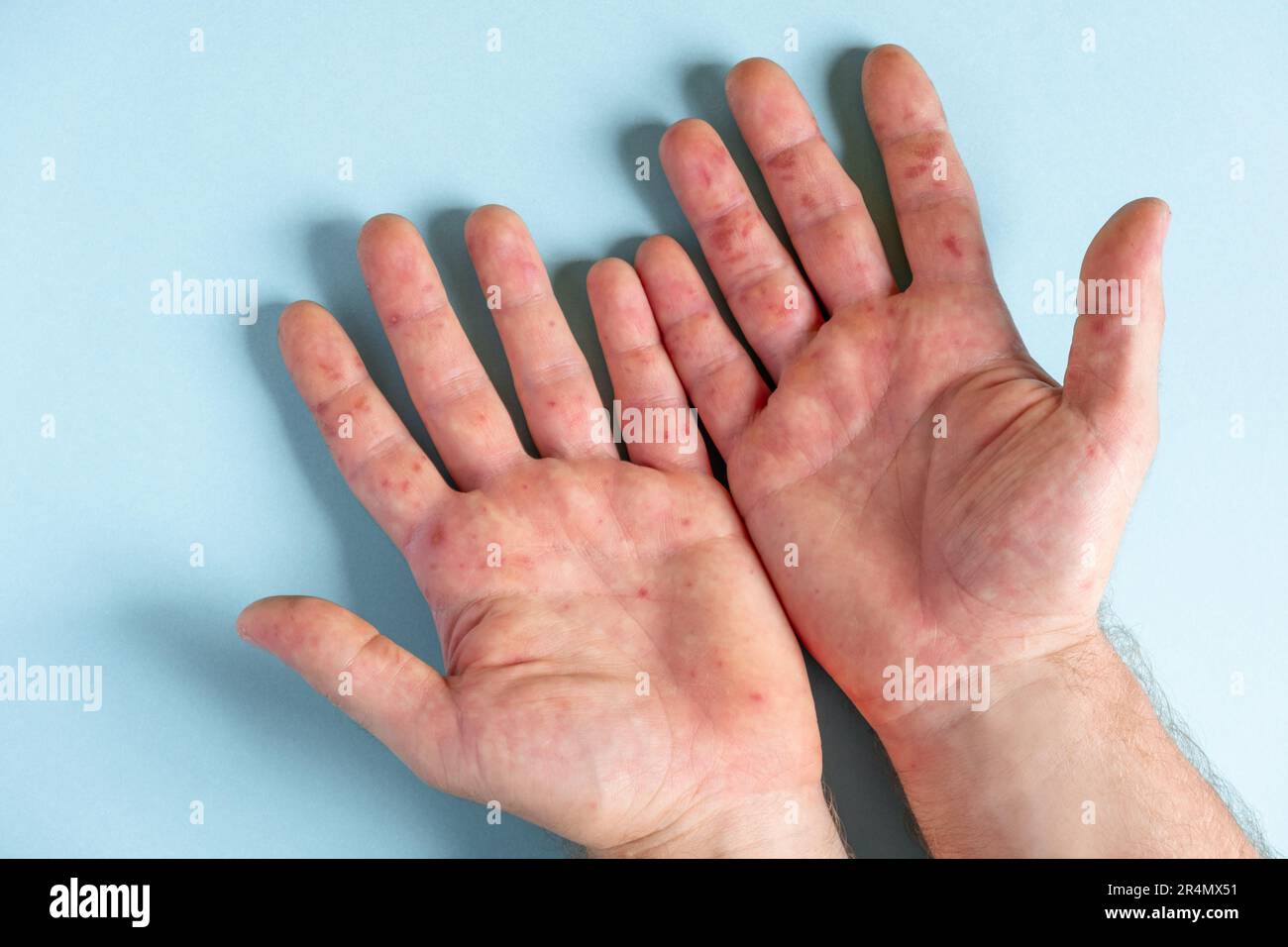 Medical Term For Painful Rash at Charles Grabowski blog