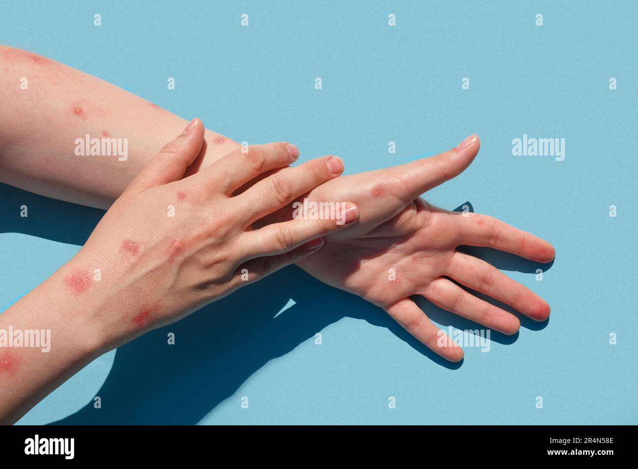 Monkeypox new disease dangerous over the world. Patient with Monkey Pox ...