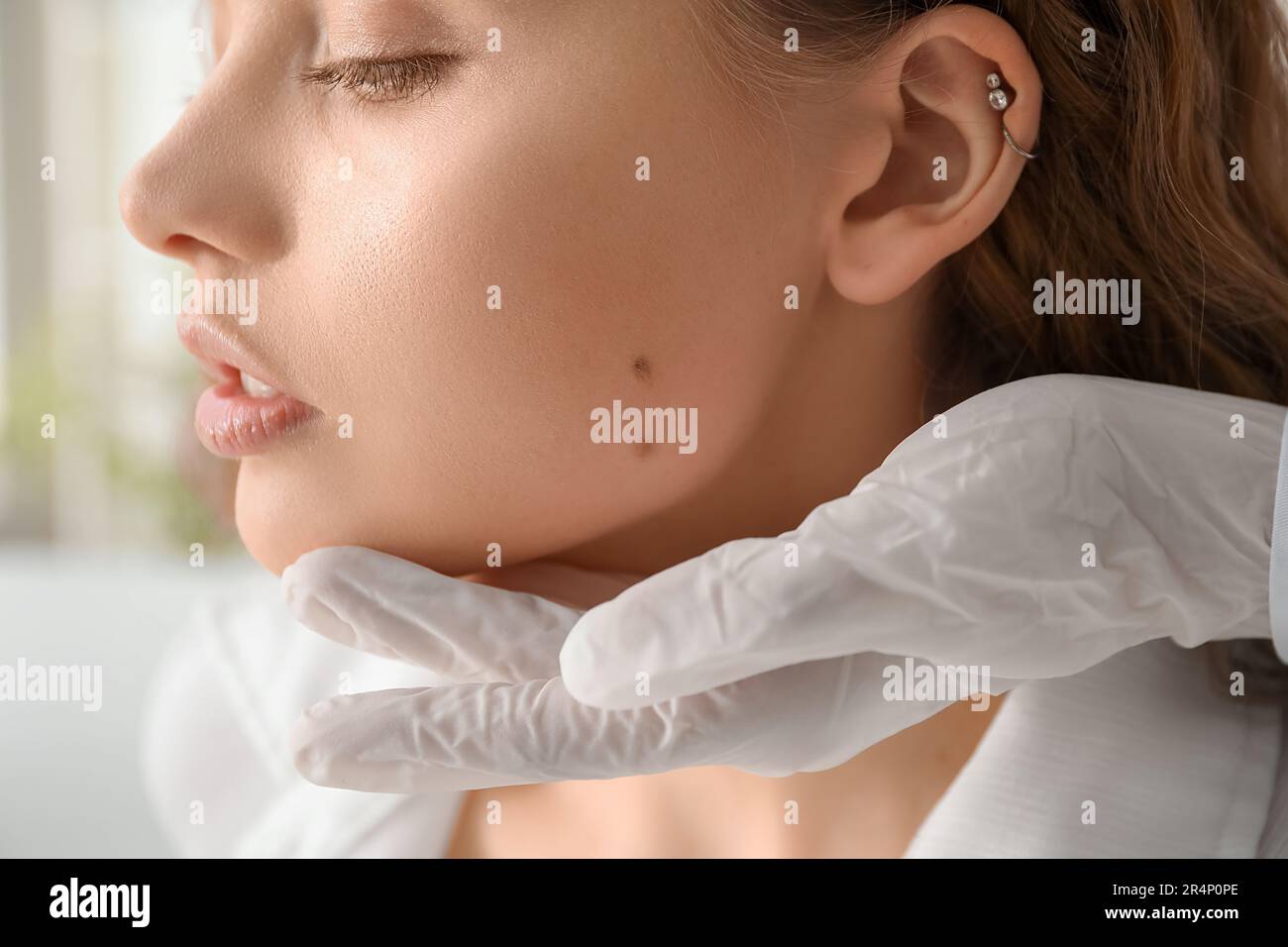 Skin cancer mole face woman hi-res stock photography and images - Alamy