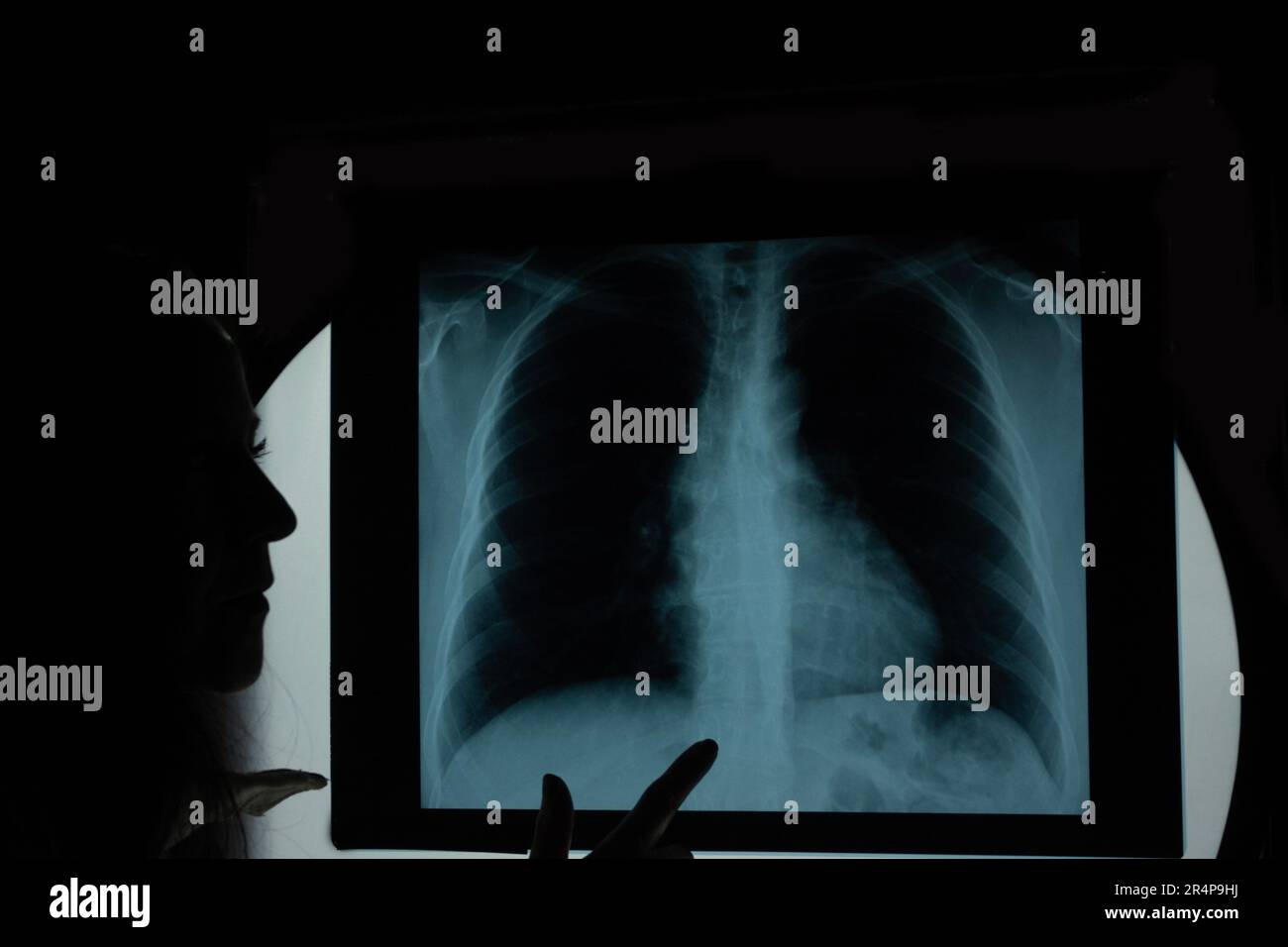 Silhouette Female pulmonologist reviewing patient's post anterior chest ...