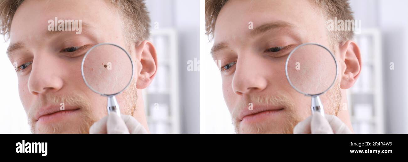 Mole removal. Collage with photos of patient's face before and after ...