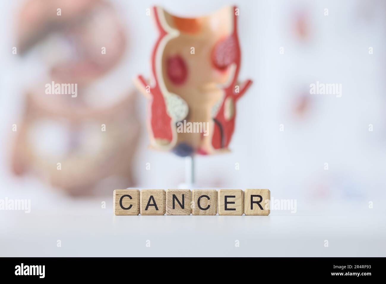 Word Cancer against realistic model of sick human rectum Stock Photo ...