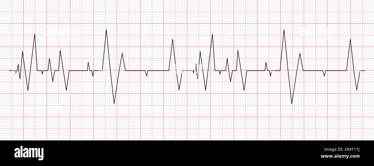 Black heartbeat diagram on red graph paper. Electrocardiogram chart ...