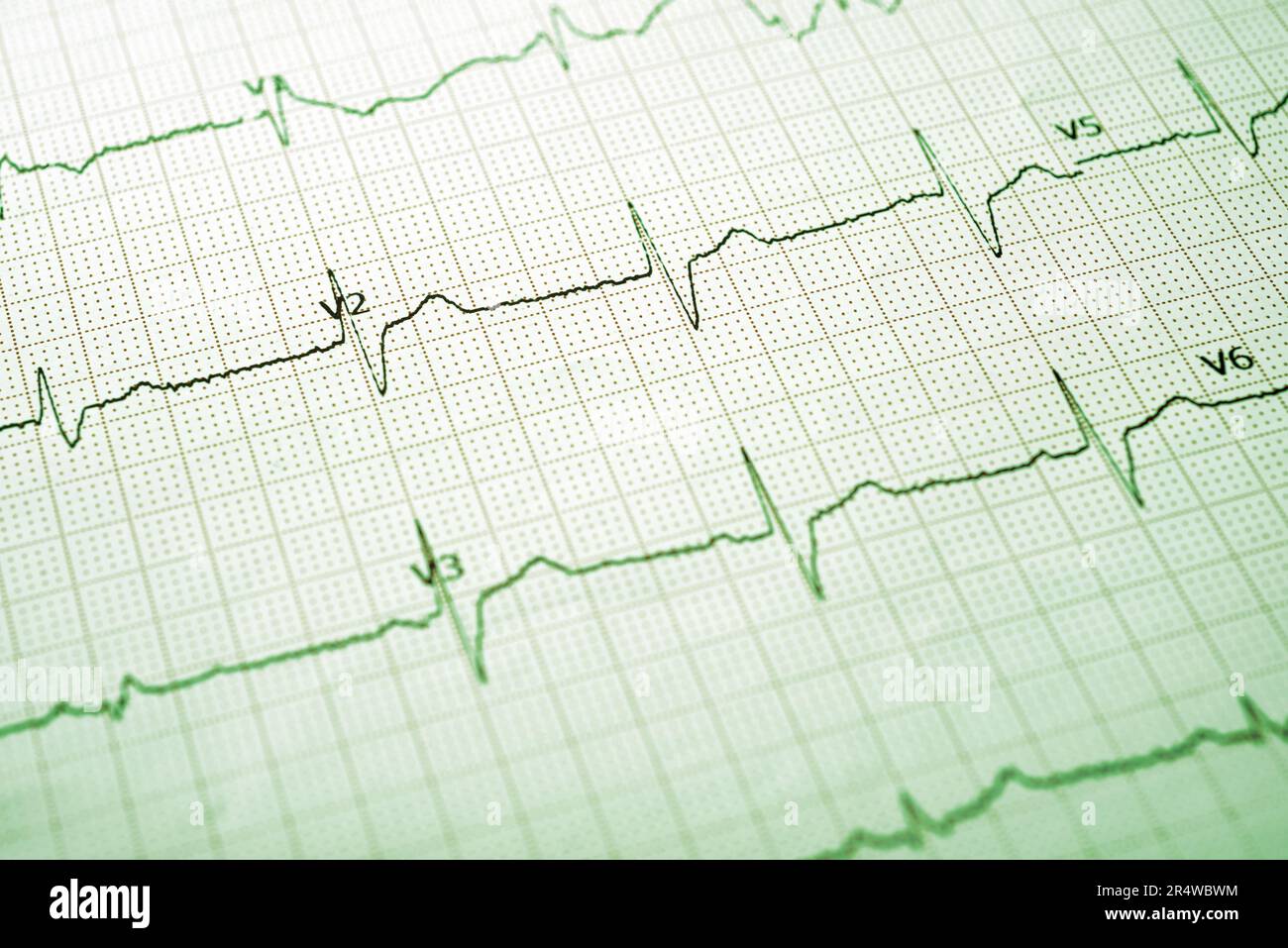 Electrocardiogram showing the pulse of the human heart Stock Photo - Alamy