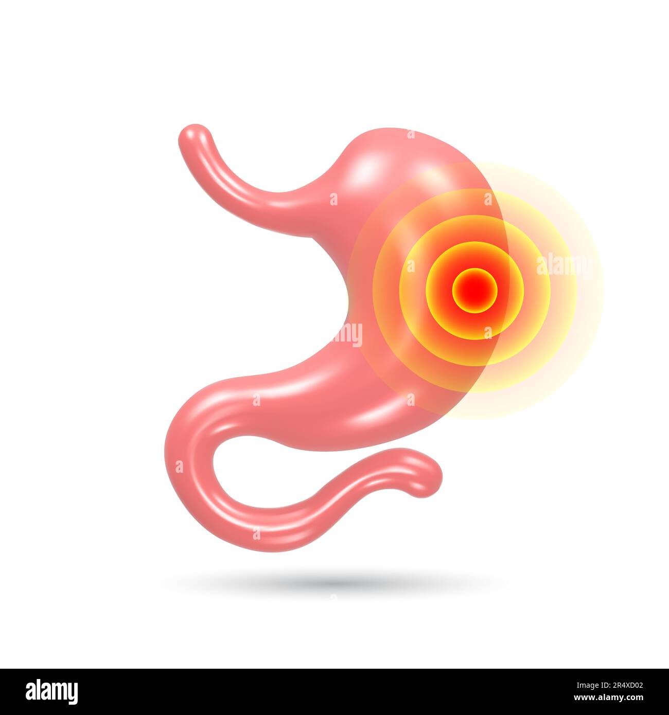 Stomach pain and heartburn. Digestive disease. Gastritis and acid ...