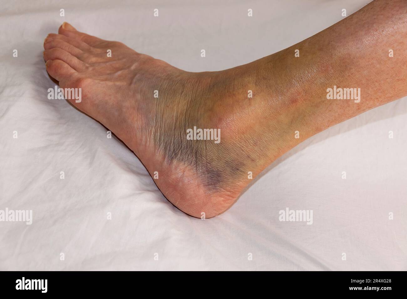 Sprained ankle hi-res stock photography and images - Alamy