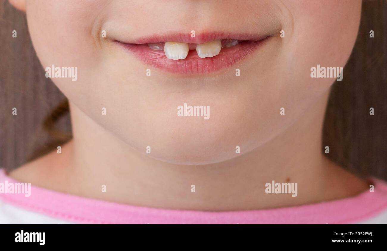 Kid with projecting upper front teeth Stock Photo - Alamy