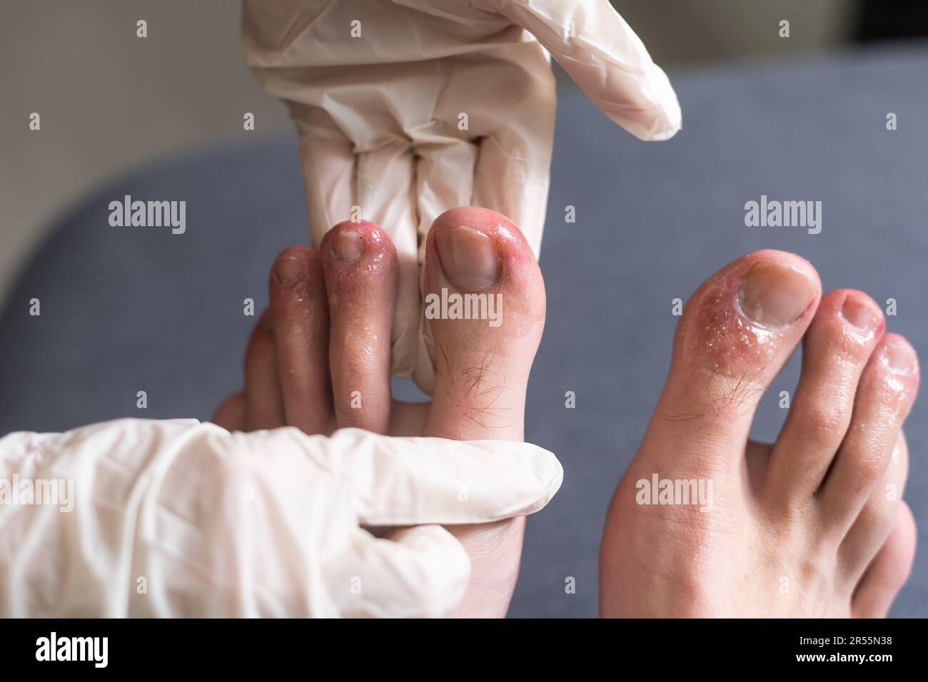 A man's toes showing what looks like a rash with red blotchy skin. A ...