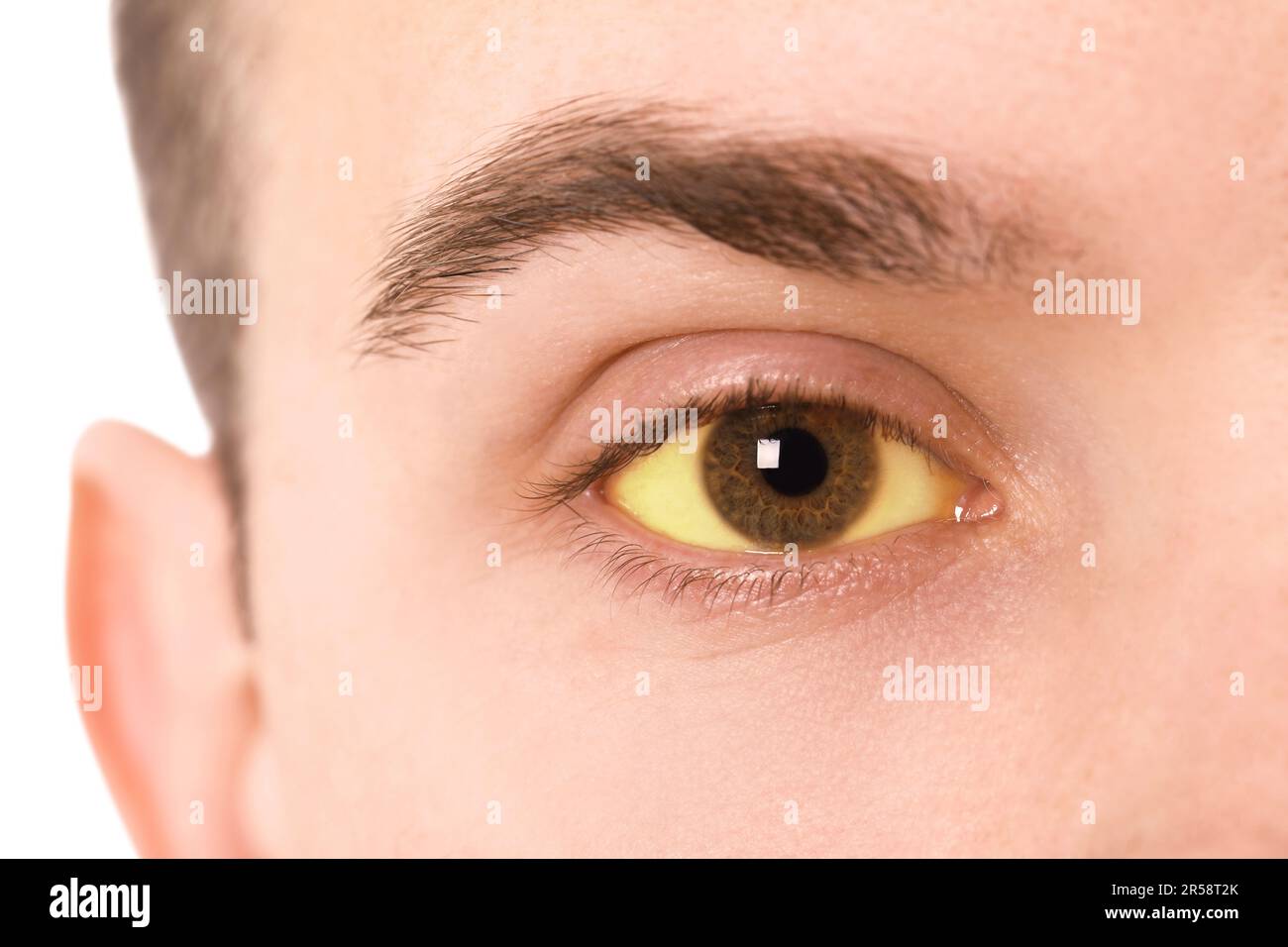 Man with yellow eyes on white background, closeup. Symptom of hepatitis ...