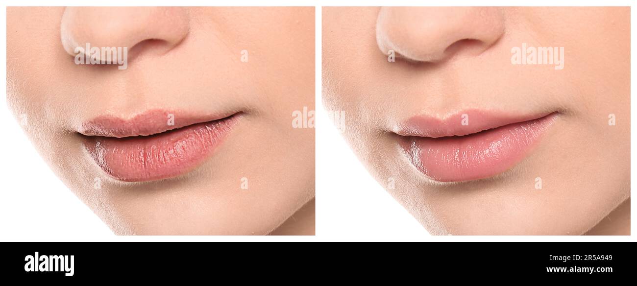Collage with photos of woman before and after using lip balm on white ...
