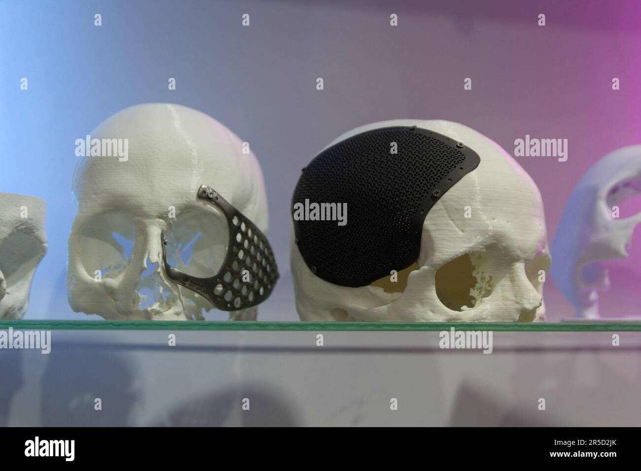 Madame of the human skull with implants made using 3D printing ...