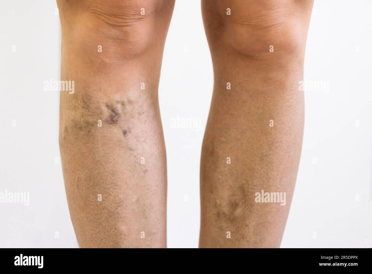 Before After Cellulite Inflammation Legs Treatment Closeup Stock Photo ...
