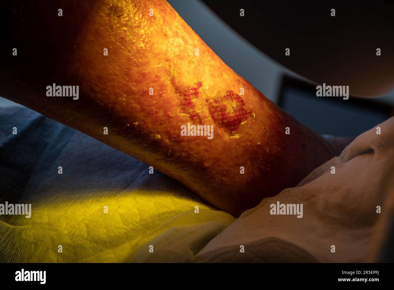 Light therapy given on ulcer (ulcus cruris Stock Photo - Alamy