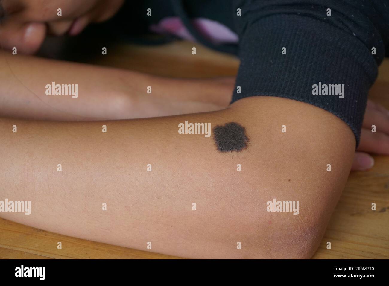 Mole birthmark on skin of a teenage hispanic girl Stock Photo - Alamy