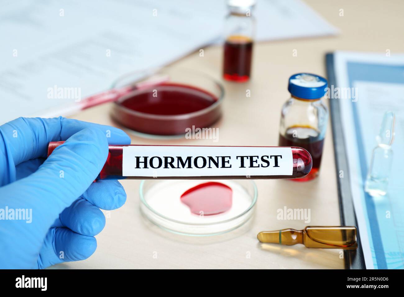 Hormones test. Scientist holding sample tube with blood at table ...