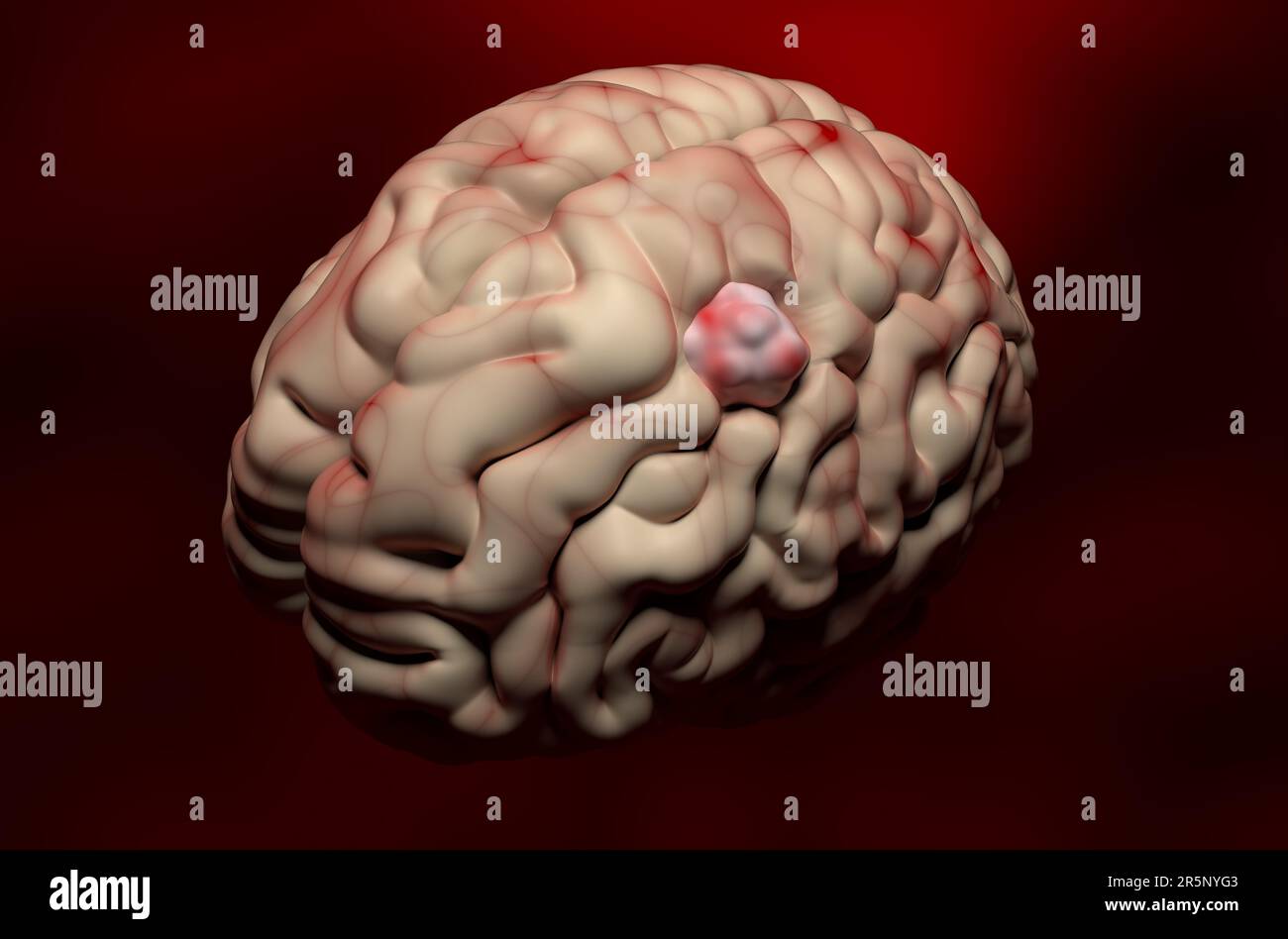 Meningioma (brain cancer) tumor in the brain tissue - 3d illustration ...