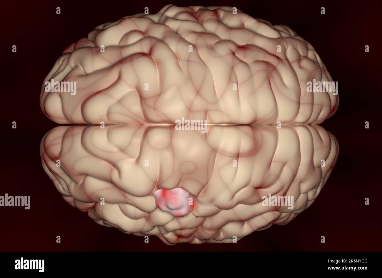 Meningioma Brain Cancer Tumor In The Brain Tissue 3d Illustration 3509