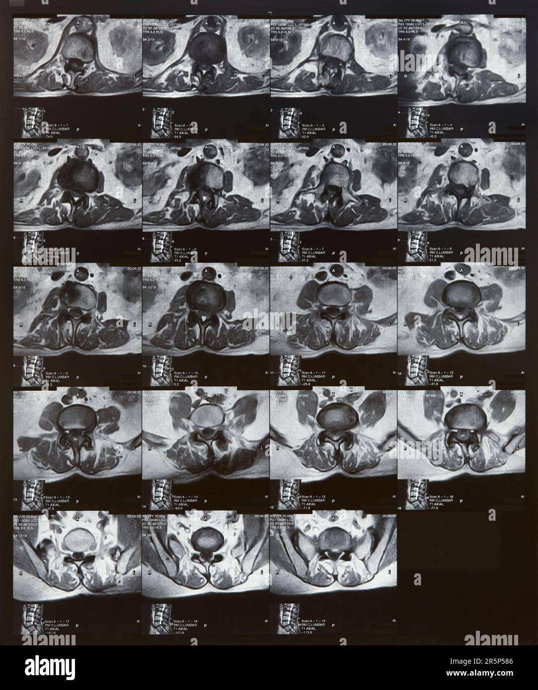 Magnetic resonance imaging. Spinal column detail. Medical procedure ...