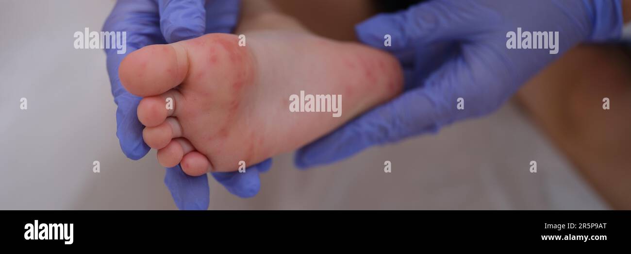 Rash with enterovirus infection of the picornavirus family on feet of ...