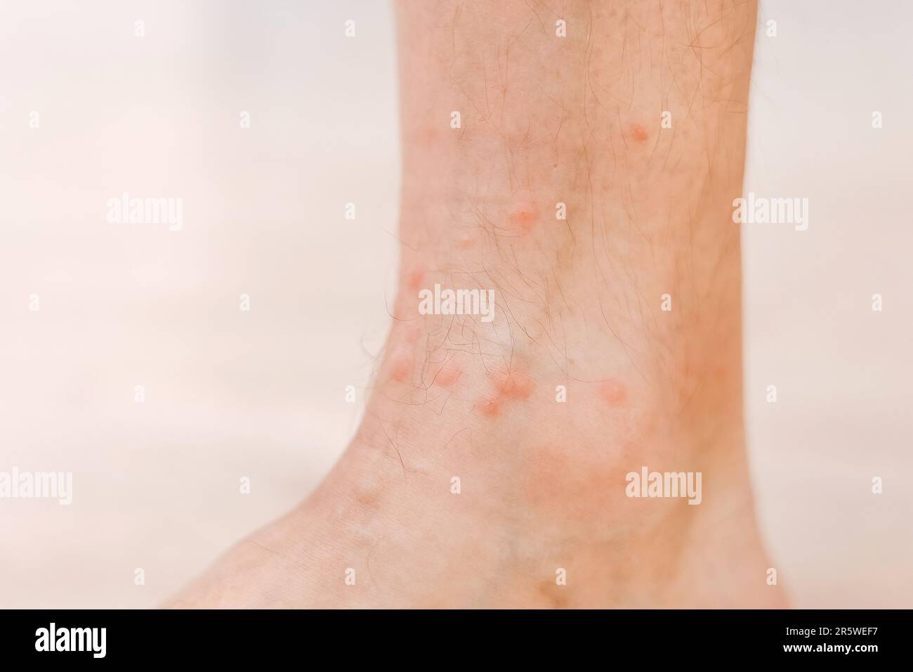 Close up allergic rash dermatitis eczema on man foot. Leg with red rash ...