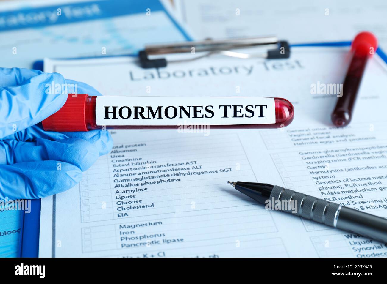 Hormones test. Scientist holding sample tube with blood against ...