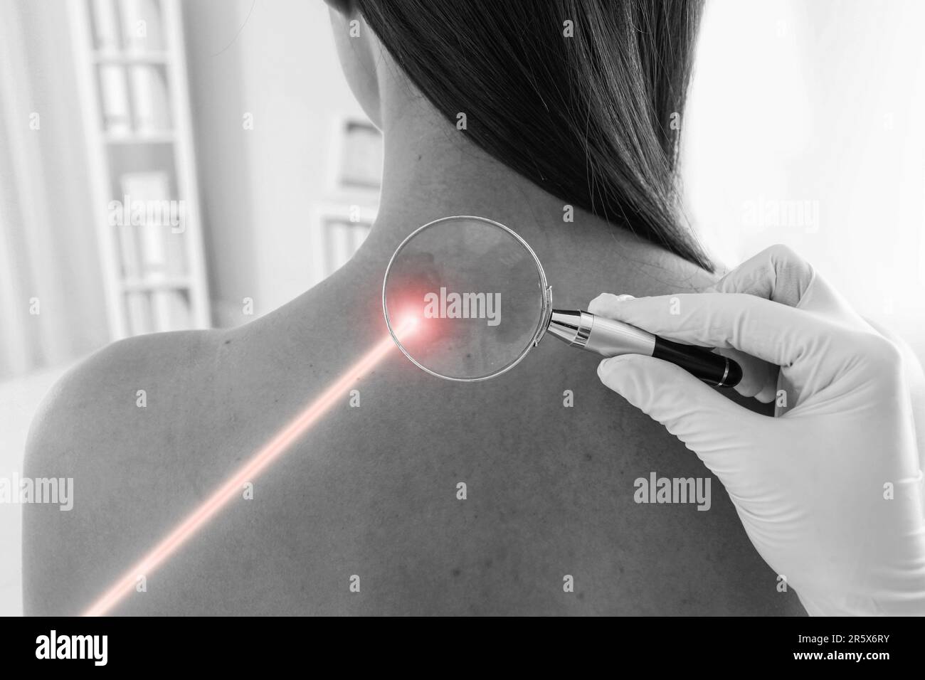 Laser mole removal. Doctor looking at patient's skin through magnifying ...