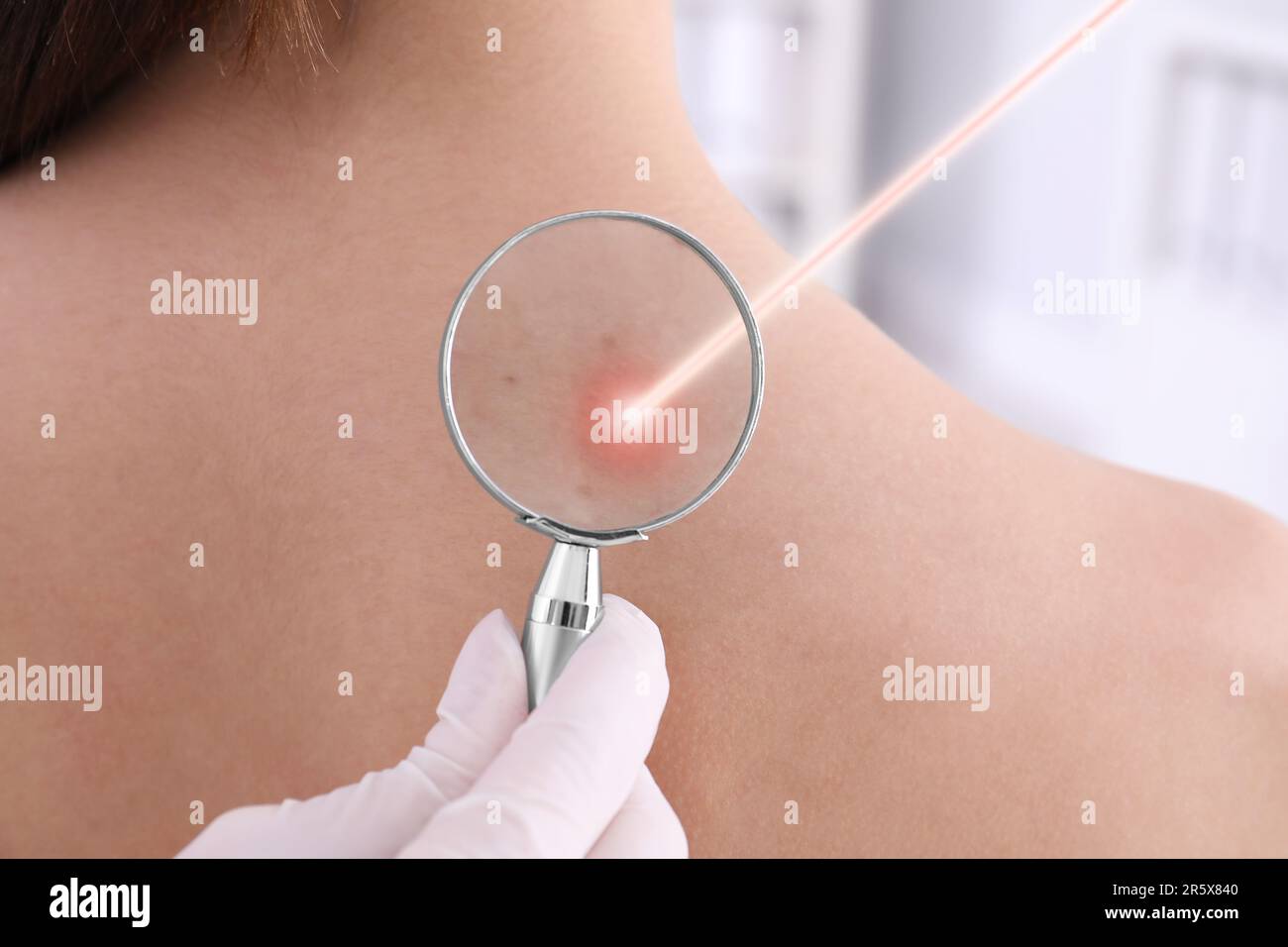 Laser mole removal. Doctor looking at patient's skin through magnifying ...