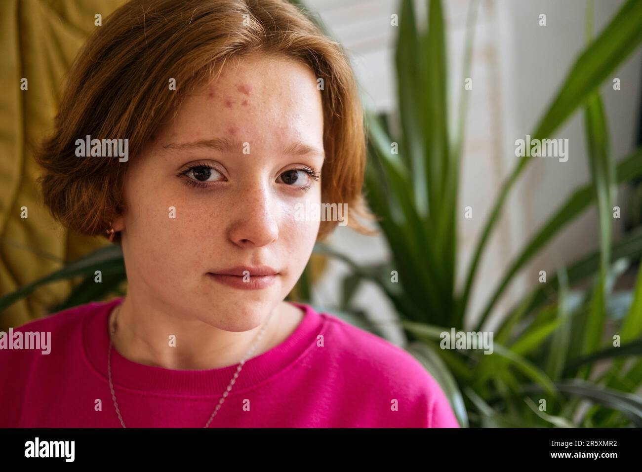 Teenage girl with acne on her face. Teenage skin imperfections. Red ...