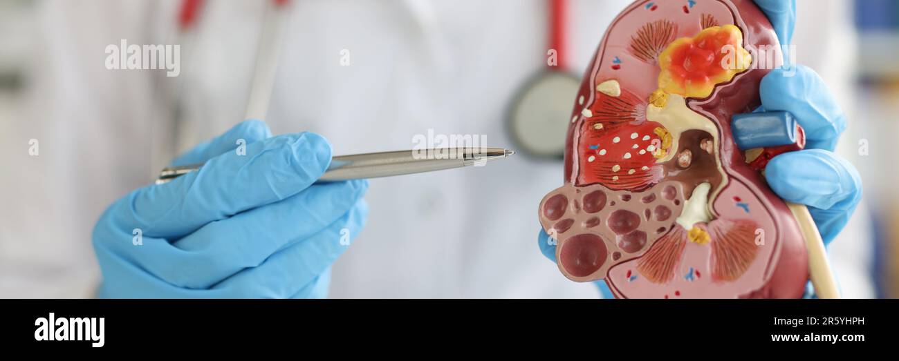 Doctor in hospital is standing holding anatomical model of kidney Stock ...