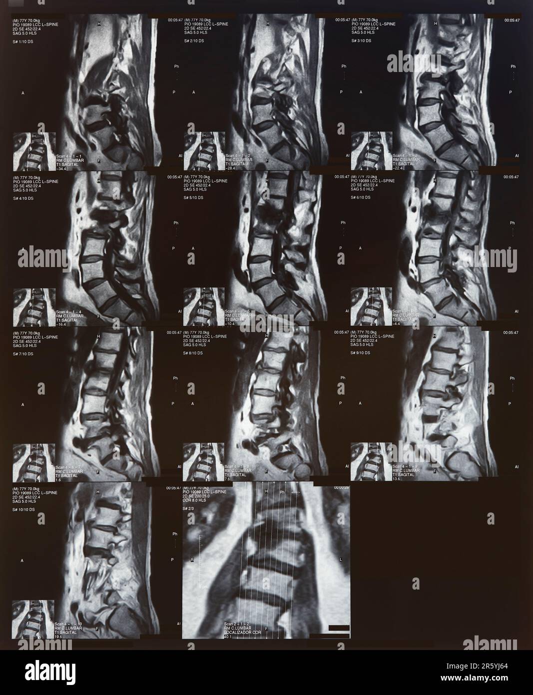 Magnetic resonance imaging. Spinal column detail. Medical procedure ...