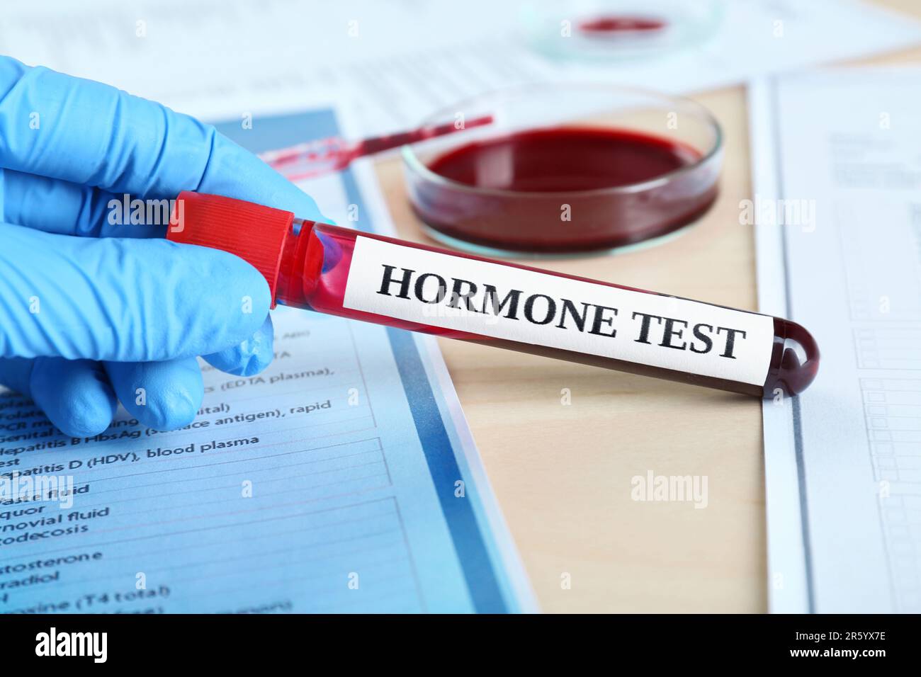 Hormones test. Scientist holding sample tube with blood at table ...