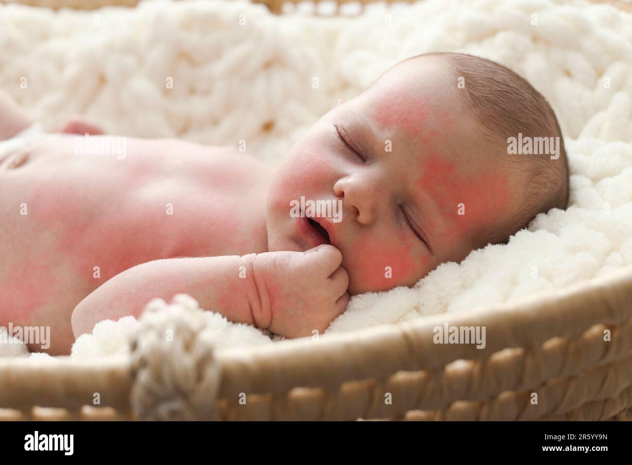 Cute little baby with allergic redness sleeping in soft cradle, closeup ...