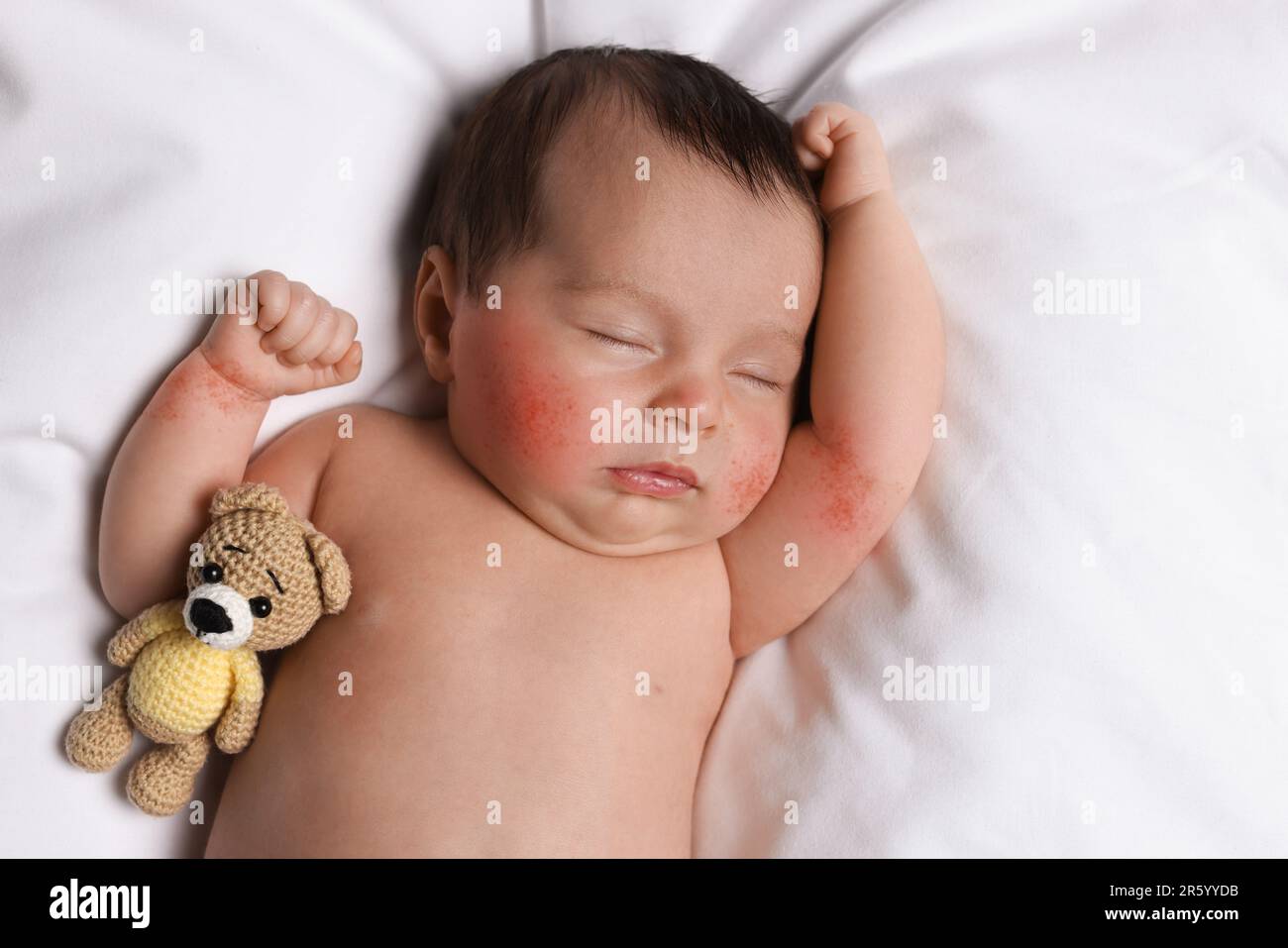 Cute little baby with allergic redness sleeping on soft bed, top view ...