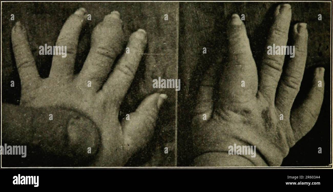 The diseases of infancy and childhood (1920 Stock Photo - Alamy