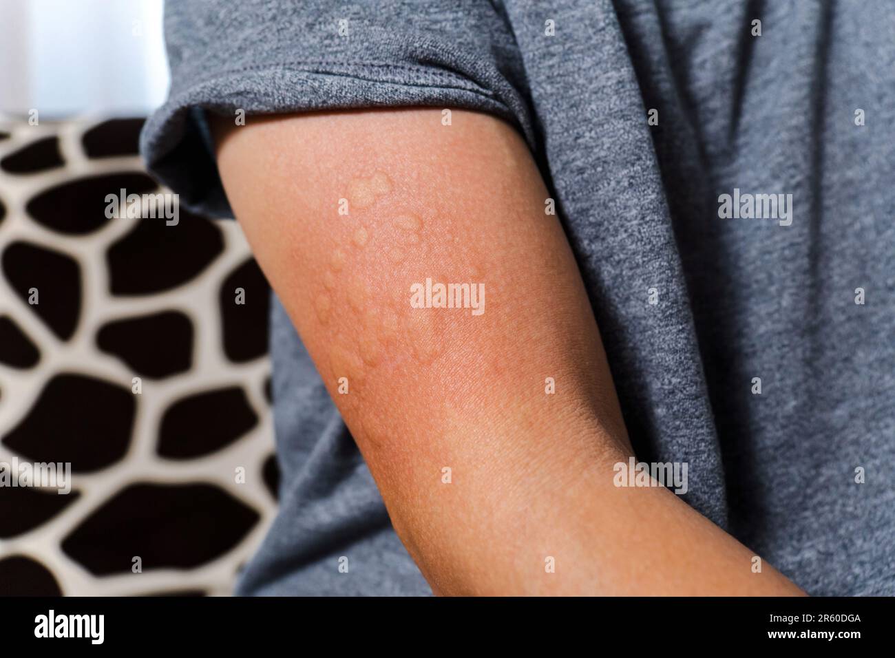 Skin rash and swelling on man arm, immunizations prevent infectious ...