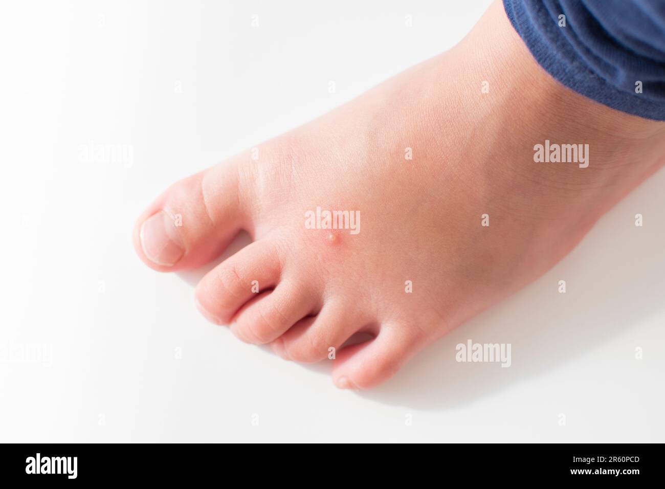 The Foot of a kid with insect bite. Fire ant bites Stock Photo - Alamy