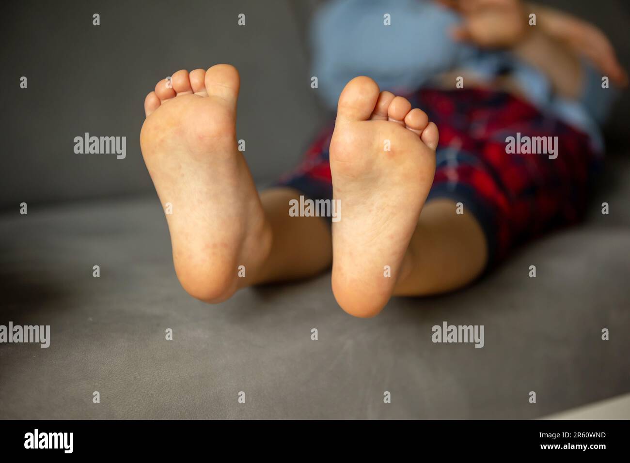 Child with skin rash, roseola, Hand-foot-and-mouth disease, child rash ...