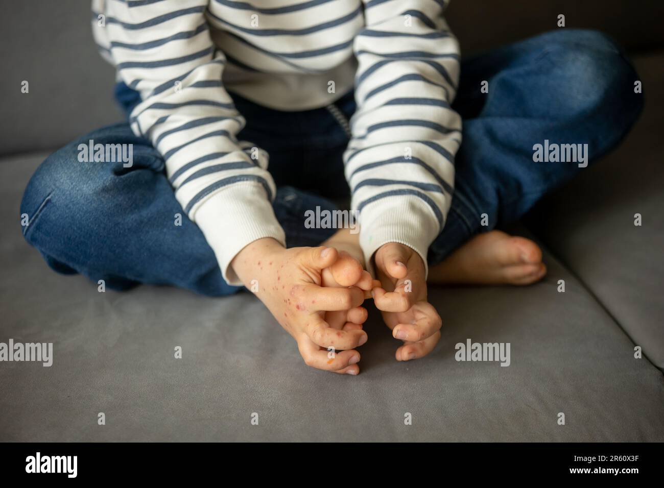 Child with skin rash, roseola, Hand-foot-and-mouth disease, child rash ...