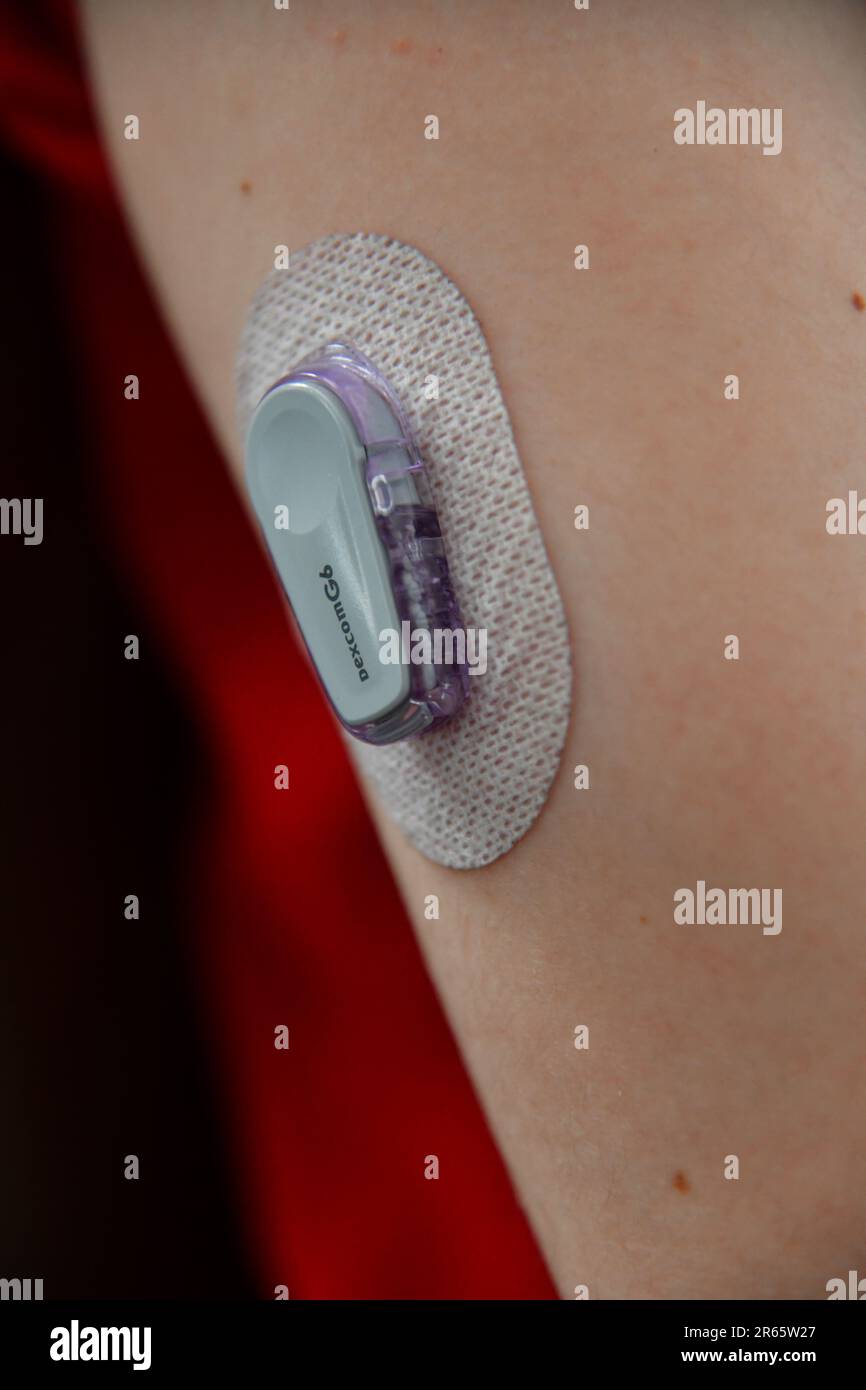 Peille, France. 03rd June, 2023. A young woman with diabetes monitors ...