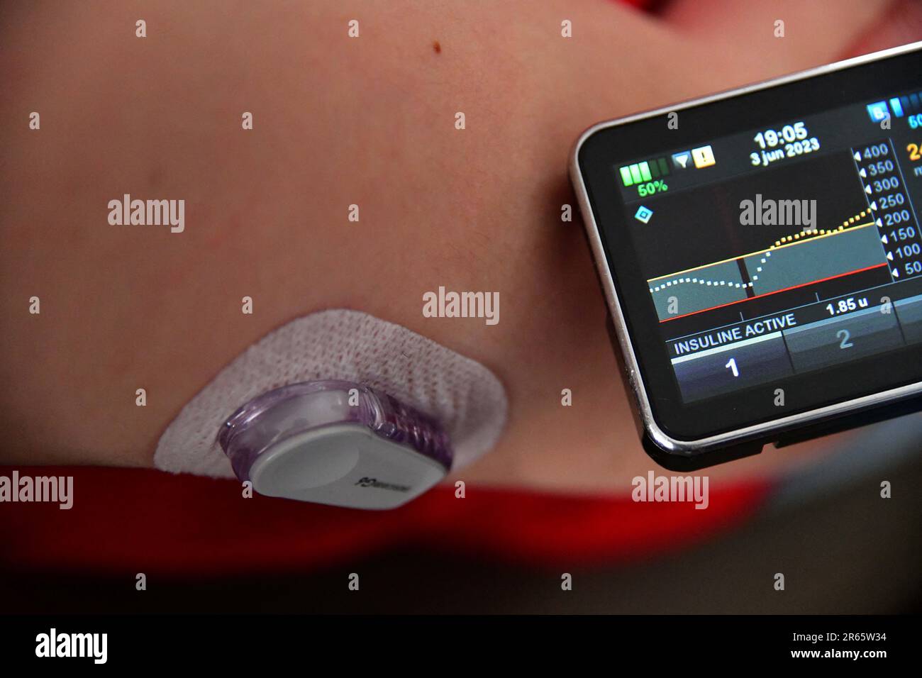 Dexcom g6 hi-res stock photography and images - Alamy