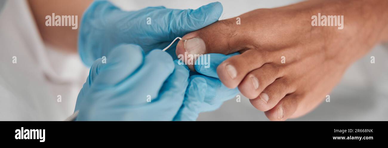 Podiatrist in blue gloves cleans toenail of man using special probe in ...