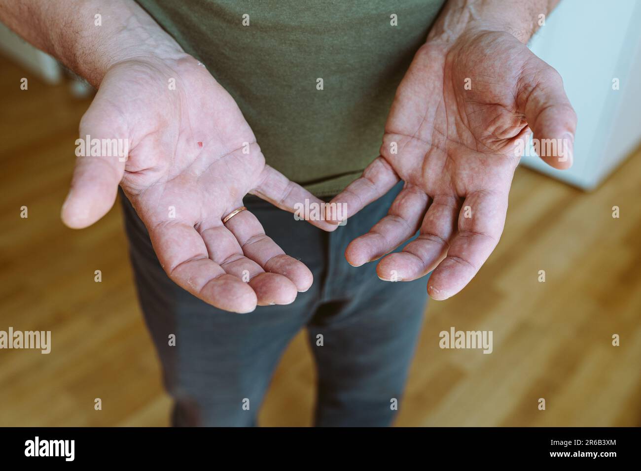 Hands man skin marbling syndrome Stock Photo - Alamy